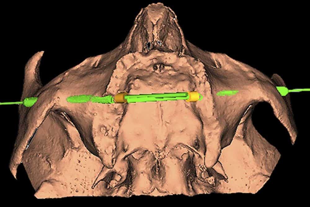 Maxillofacial surgery in Costa Rica: How 3D computer tomography ...